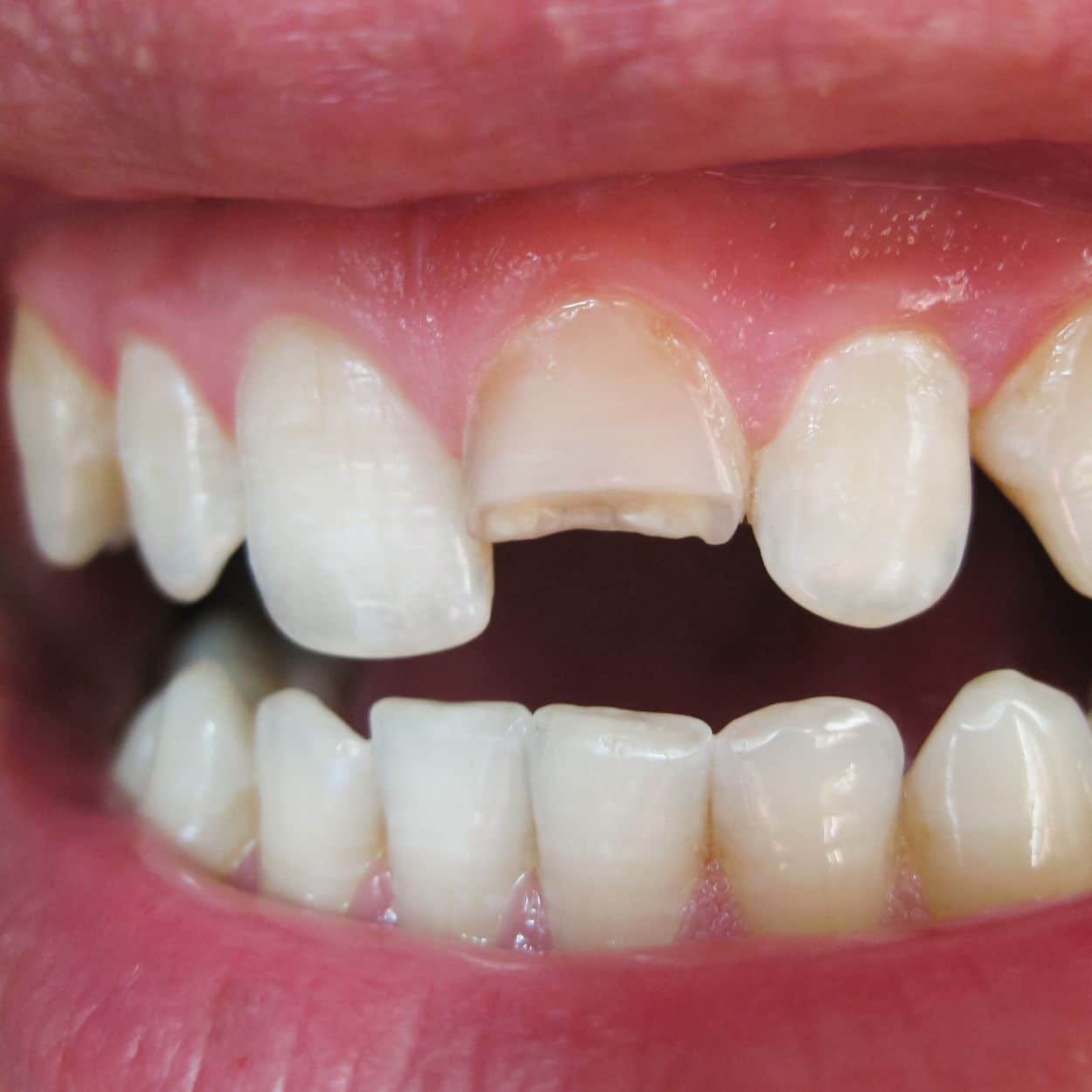 Dealing with a Broken Tooth: Causes, Symptoms, and Treatment Options ...